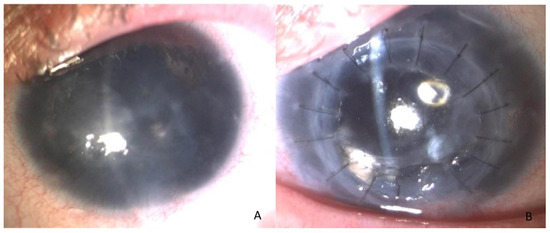 The Triple Procedure in Patients with Congenital Aniridia