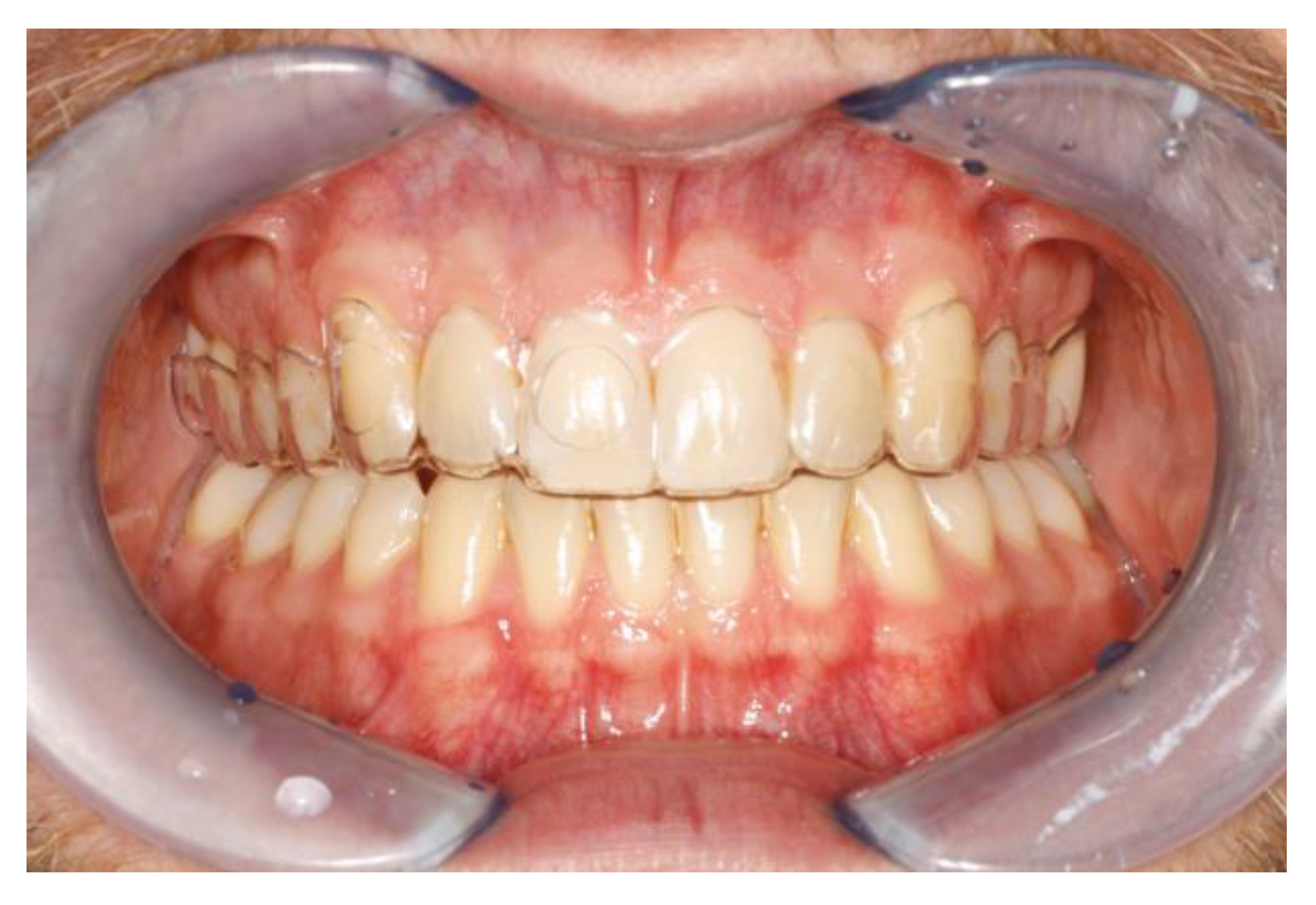 Comparison of the Clinical Evaluation of Digital Tooth Shade ...
