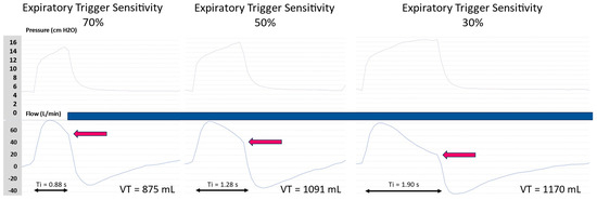 Cycling the Breath in Noninvasive Home Ventilation