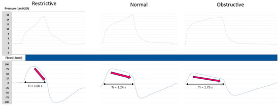 Cycling the Breath in Noninvasive Home Ventilation