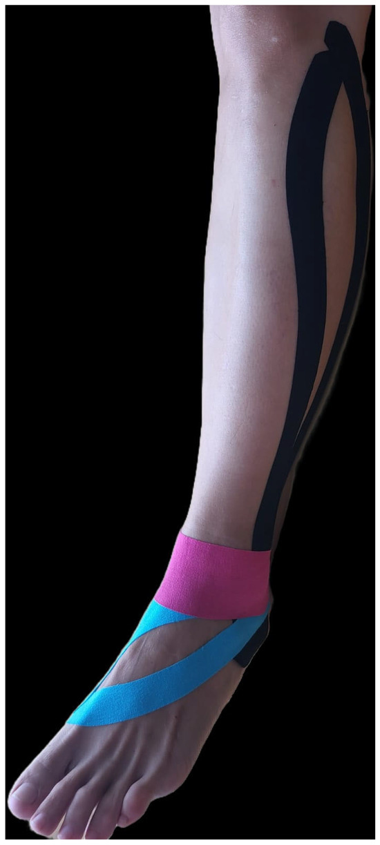 Ankle Taping Does Not Affect Running Kinematics During a Treadmill ...