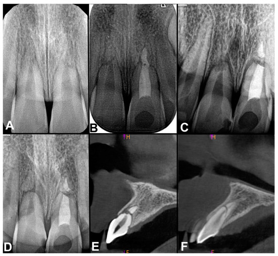 Management of Complex Root Fractures in Young Patients—Case Series and ...
