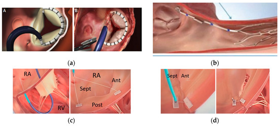 Transcatheter Tricuspid Regurgitation Repair—An Overview of Techniques ...