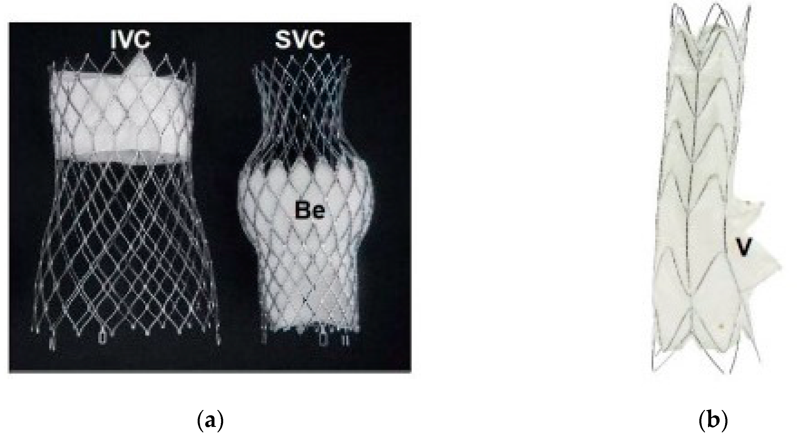 Transcatheter Tricuspid Regurgitation Repair—An Overview of Techniques ...