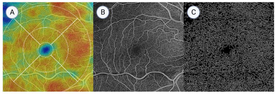 Perifoveal Exudative Vascular Anomalous Complex (PEVAC): Retinal ...