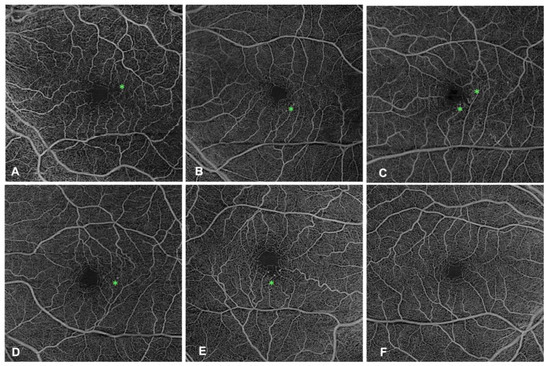 Perifoveal Exudative Vascular Anomalous Complex (PEVAC): Retinal ...