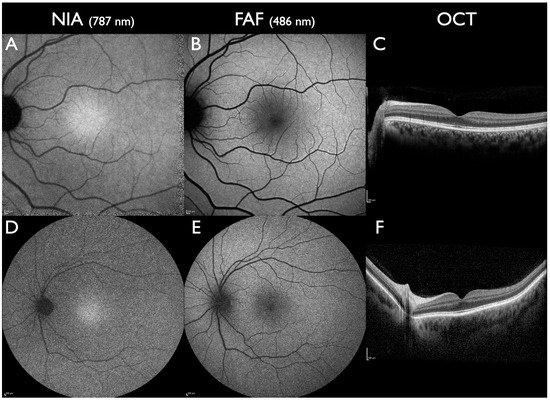 Near-Infrared Autofluorescence: Early Detection of Retinal Pigment ...