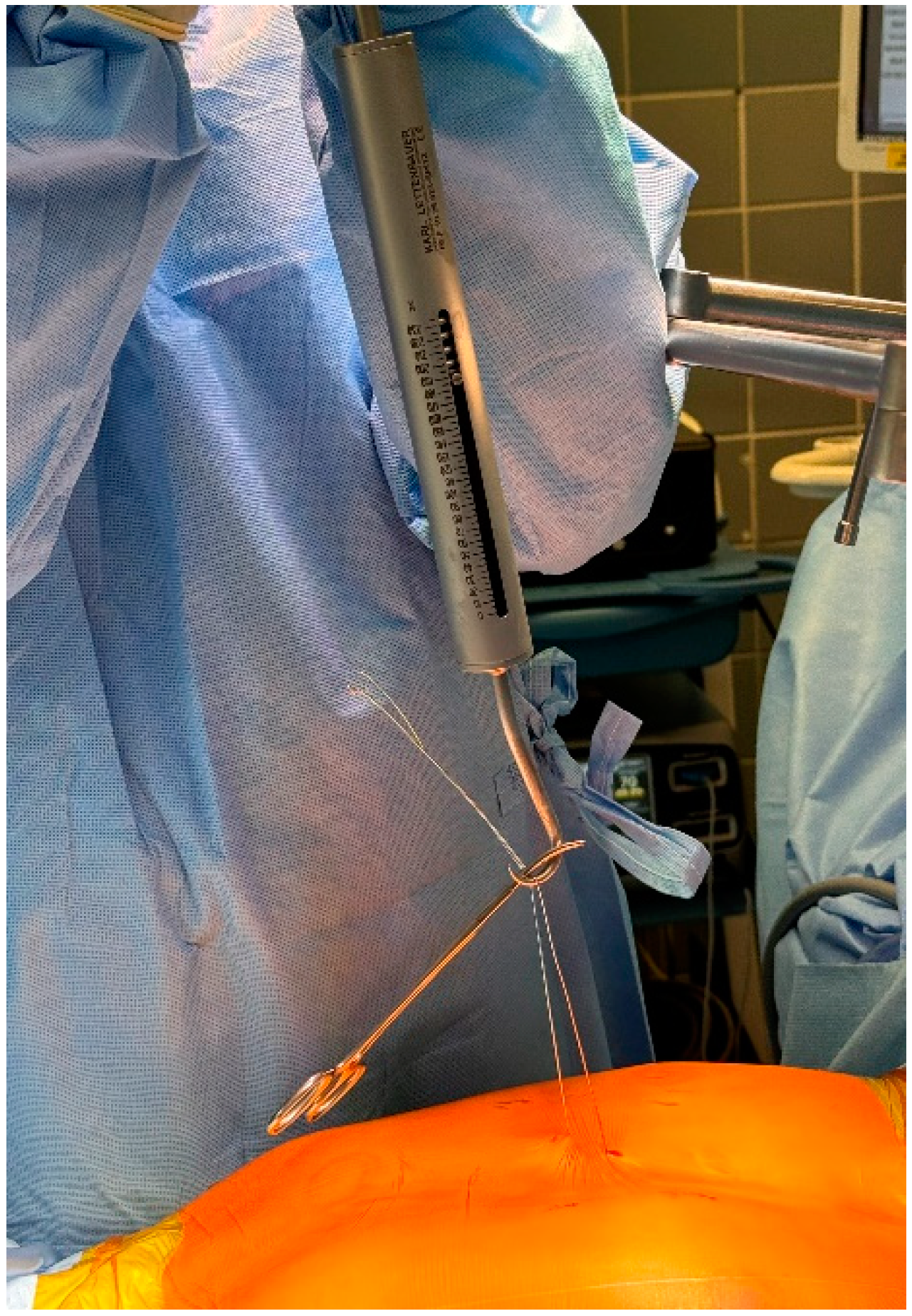 Minimally Invasive Repair of Pectus Excavatum: A Lifeline to Quality of ...