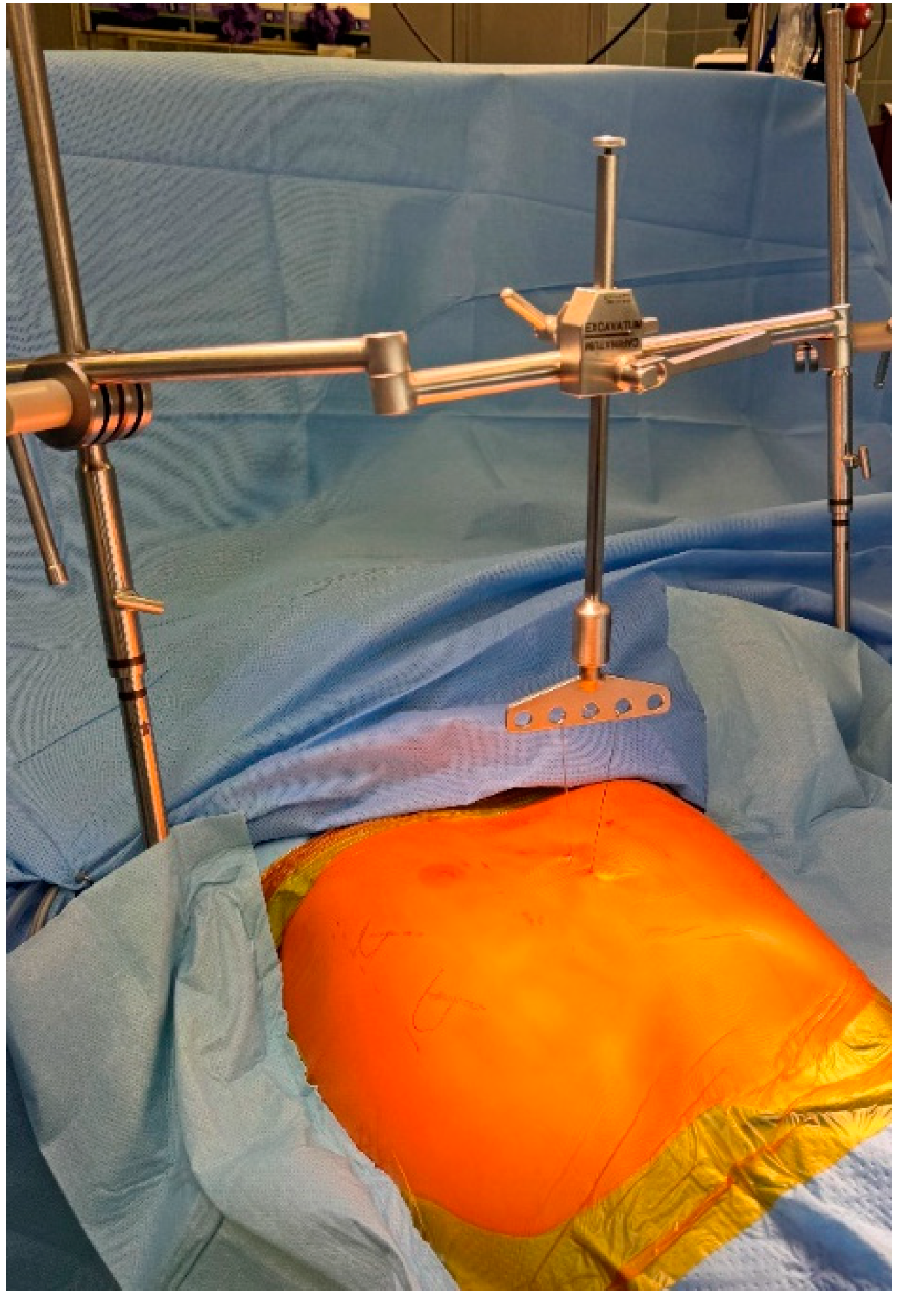 Minimally Invasive Repair of Pectus Excavatum: A Lifeline to Quality of ...