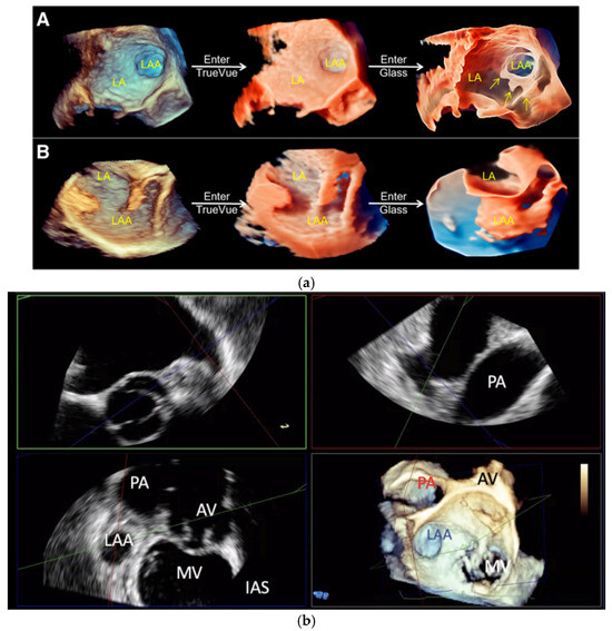 Advancements in 3D Transoesophageal Echocardiography (TOE) and Computed ...