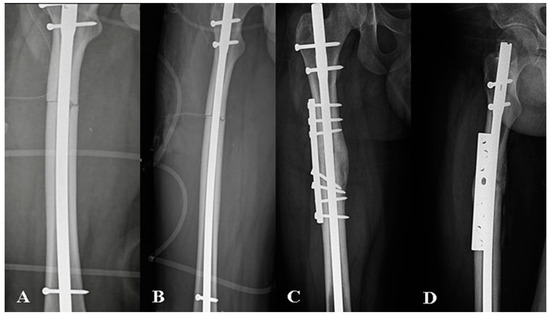 Comparative Study of Exchange Nailing and Augmentative Plating for Treating Aseptic Nonunion of ...