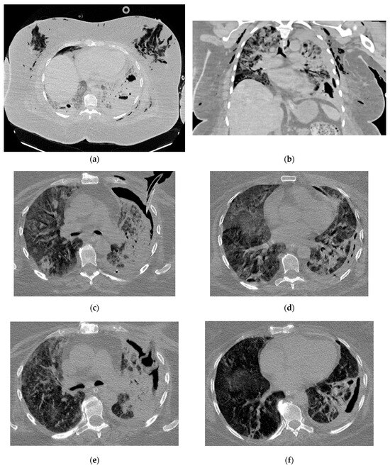 Management of COVID-19 Infection Associated Lung Abscess with Secondary ...