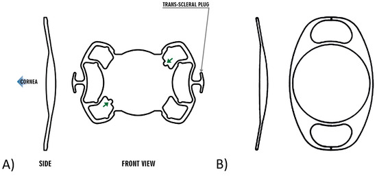 A Comparative Analysis of Carlevale IOL Versus Artisan IOL Implantation ...