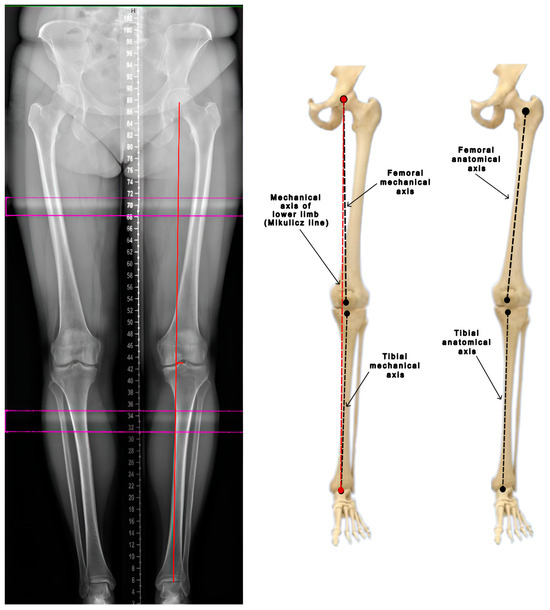 Radiological Approach to Assessment of Lower-Limb Alignment—Coronal and ...