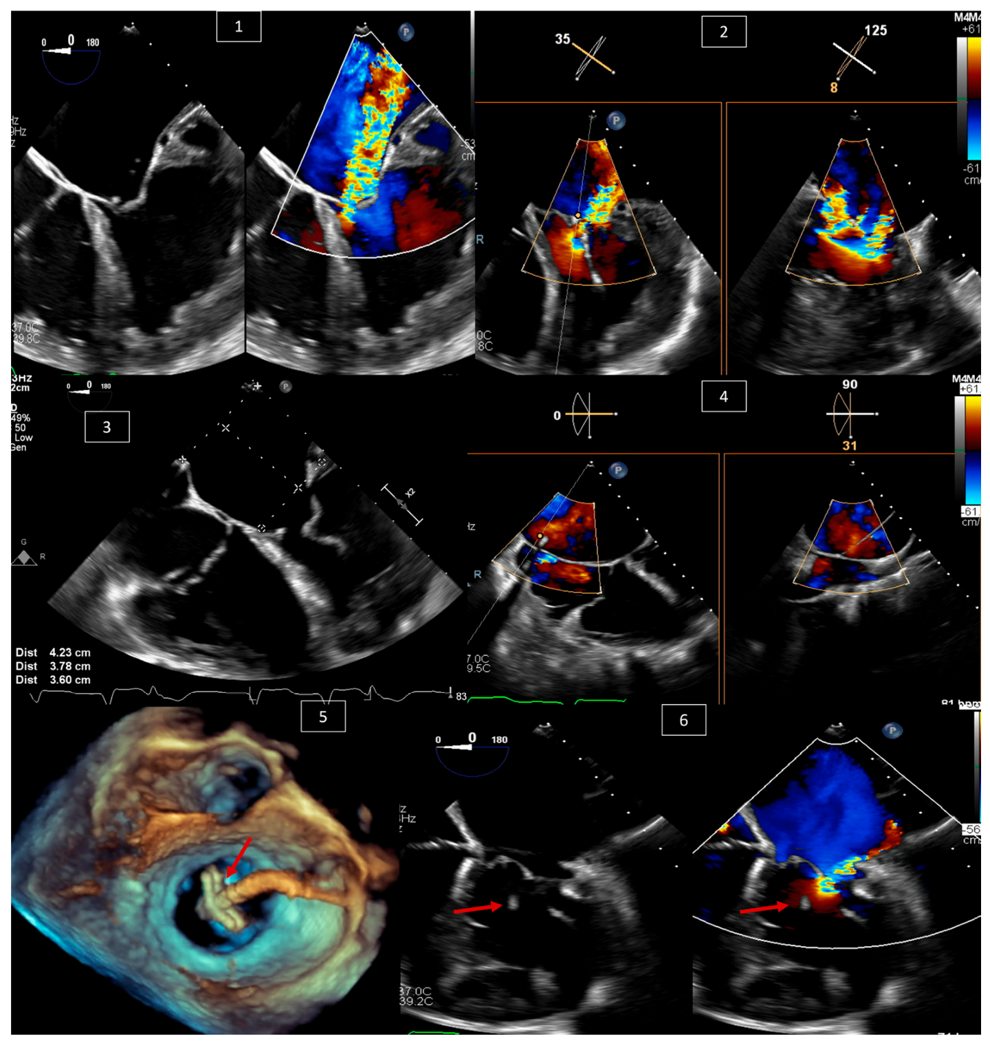 Highlights of Transesophageal Echocardiography During Interventions for ...