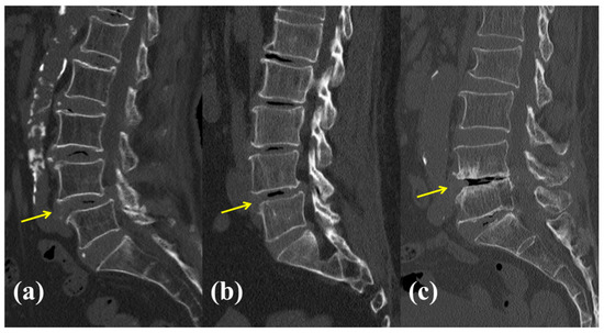 Effects of Vacuum Phenomenon on Cage Subsidence and Fusion Outcomes in ...