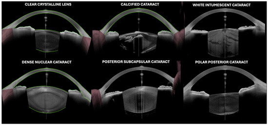 The Clinical Usefulness of Evaluating the Lens and Intraocular Lenses ...
