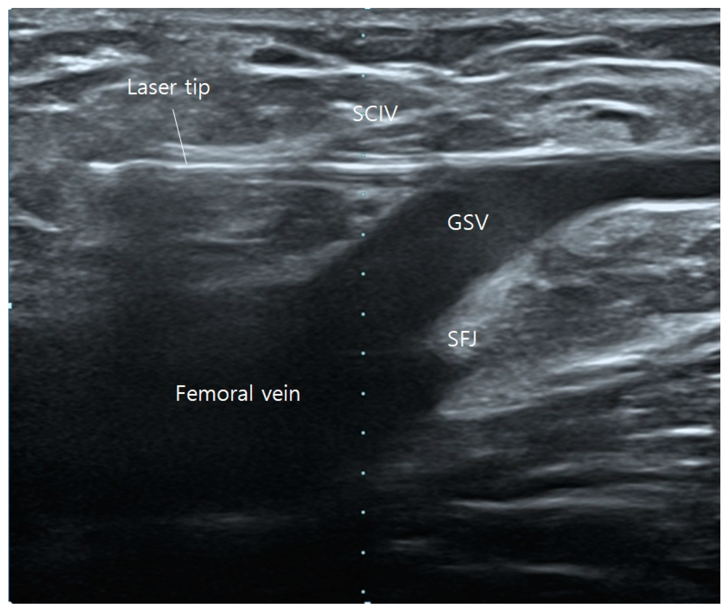 Feasibility and Safety of Flush Endovenous Thermal Ablation of the ...