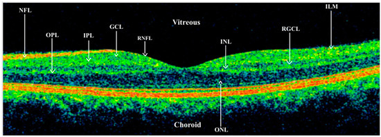 Retinal Ganglion Cell Replacement in Glaucoma Therapy: A Narrative Review