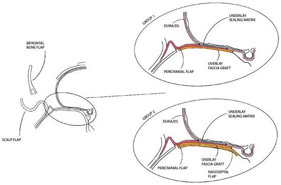 Anterior Skull Base Reconstruction in Multiportal Approaches: Insight into Vascularized Flap ...