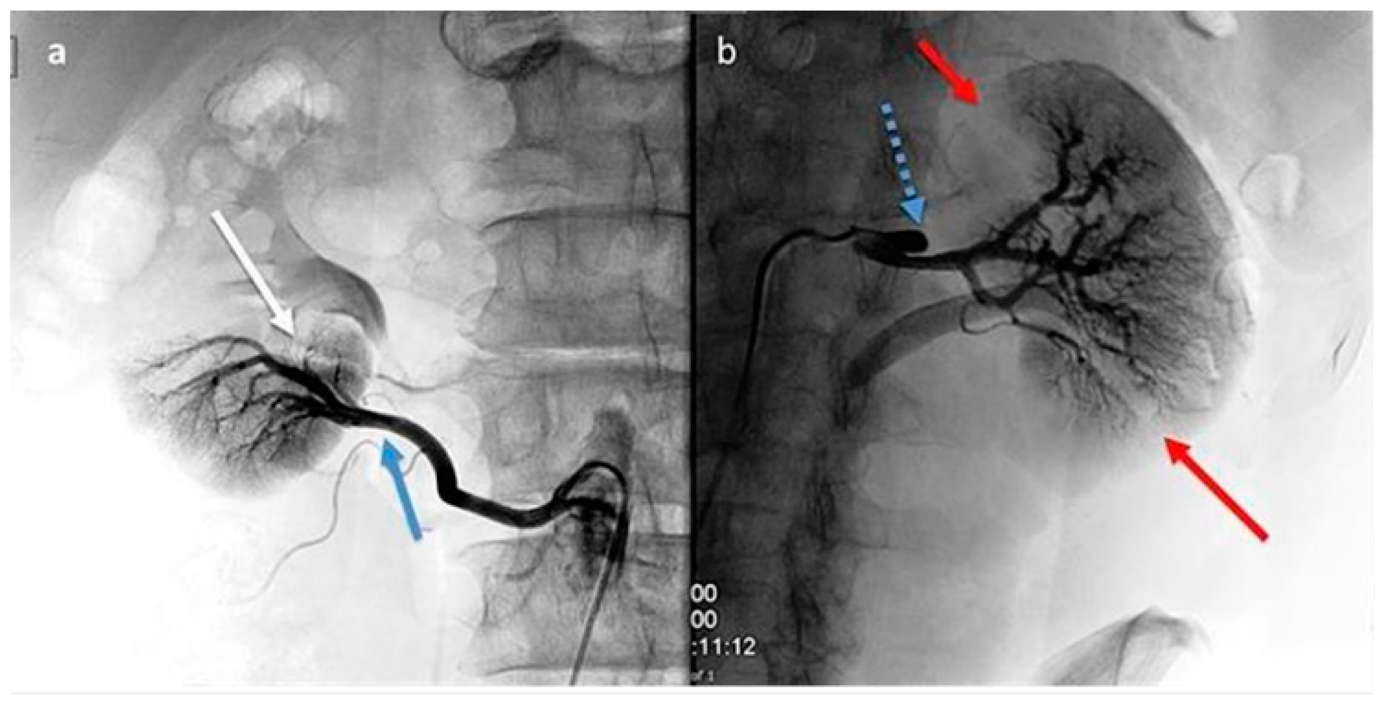 Multiple Renal Infarctions in Spontaneous Double Renal Artery ...