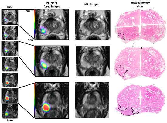 A Pilot Study of PSMA PET/CT and MRI Fusion for Prostate Cancer ...