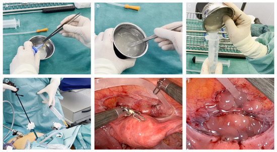 Adhesion Prevention in Gynecologic Surgery: Guidance and Clinical ...