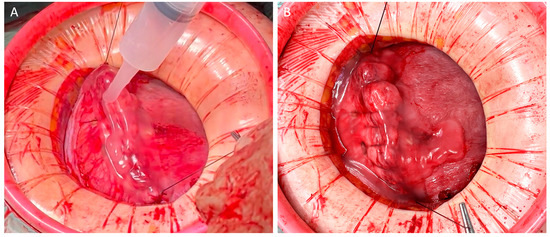 Adhesion Prevention in Gynecologic Surgery: Guidance and Clinical ...