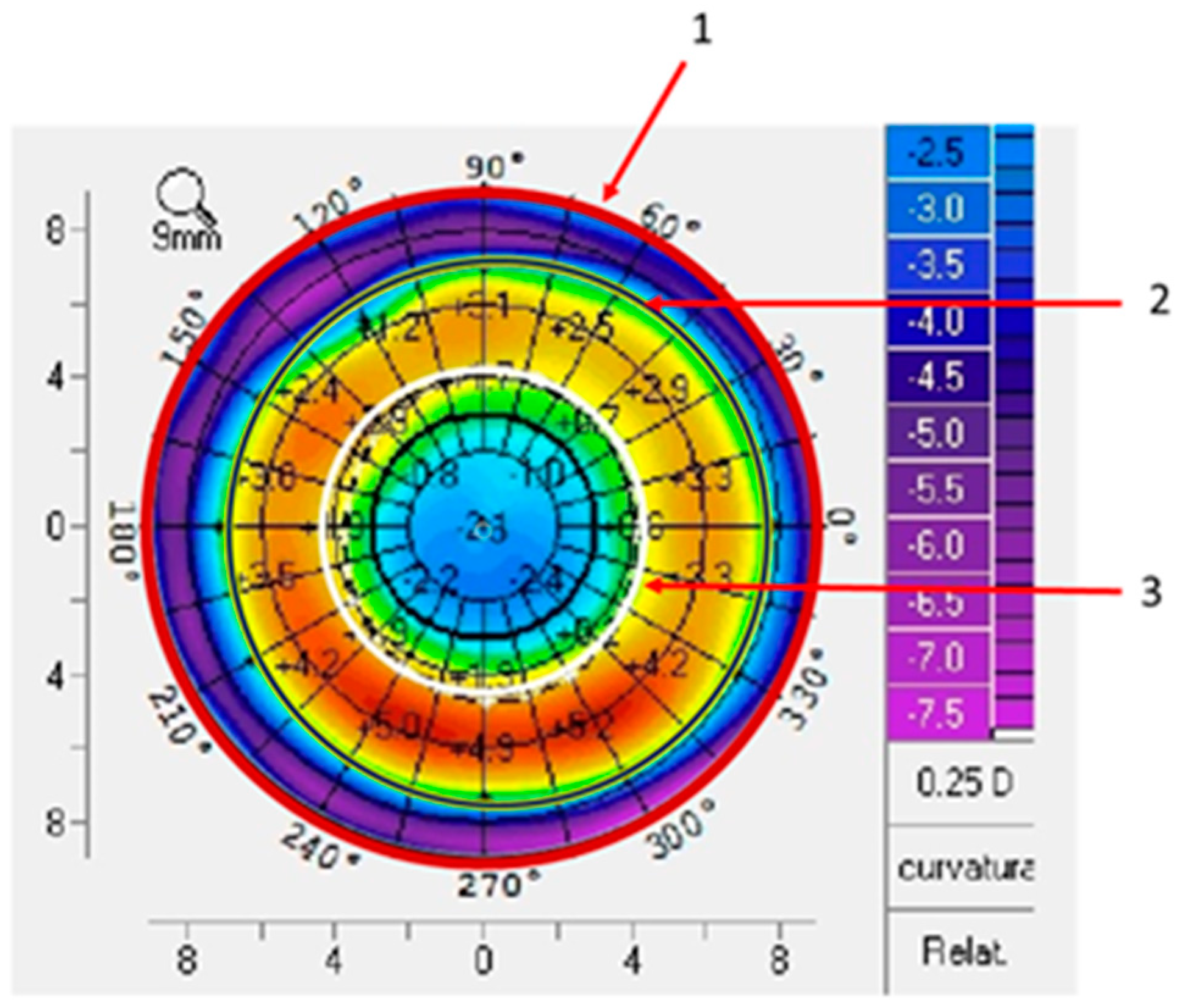 Orthokeratology Lens Decentration with Two Designs of Corneal ...