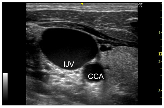 Risk Factors for Internal Jugular Vein Thrombosis 1 Month After Non ...