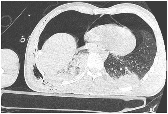 Pneumopericardium, a Heart in a Trap