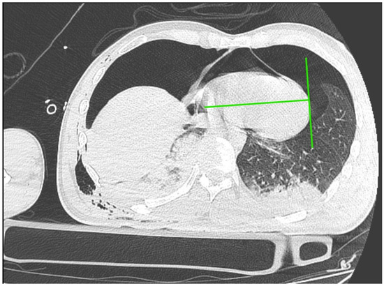 Pneumopericardium, a Heart in a Trap