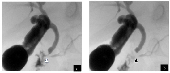 Pancreaticobiliary Reflux with Normal and Relatively Long Common ...