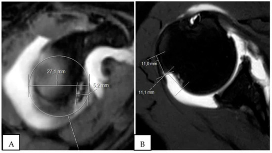 The Radiologic Evaluation and Clinical Significance of Glenohumeral ...