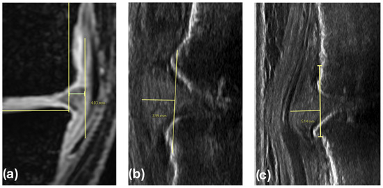 Meniscal Extrusion Correlates with Symptom Severity in Knee ...