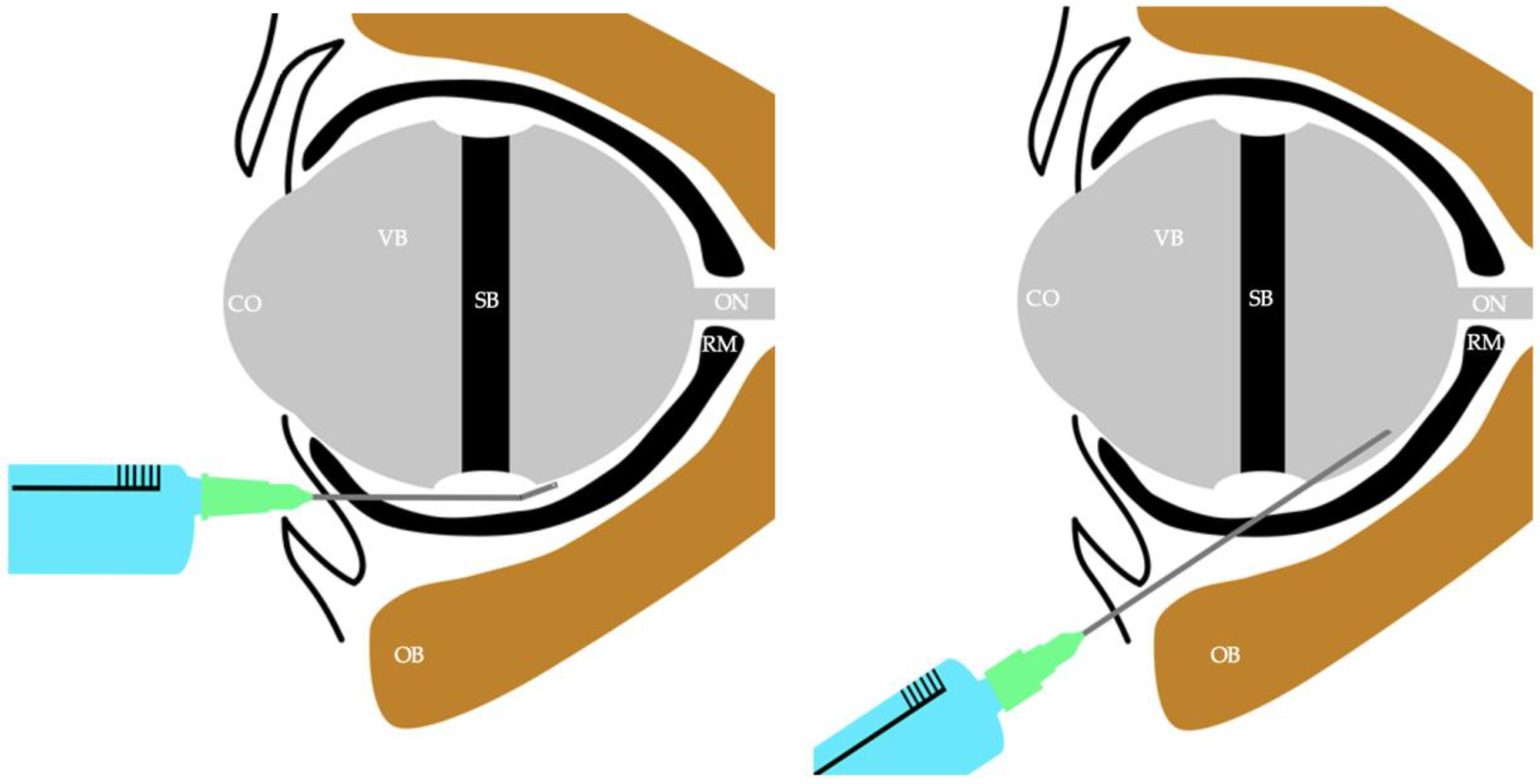 Sub-Tenon’s Block in Patients with Previous Encircling Band Surgery—A ...