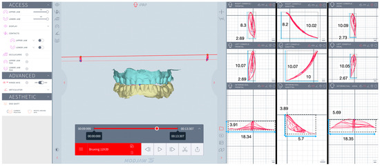 Condylar Parameters and Mandibular Movement Patterns in Bruxers Using ...