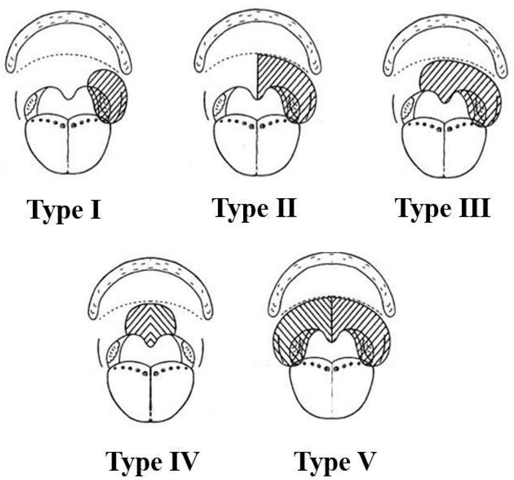New Classification System and Defect-Oriented Algorithm for Functional Soft-Palate ...