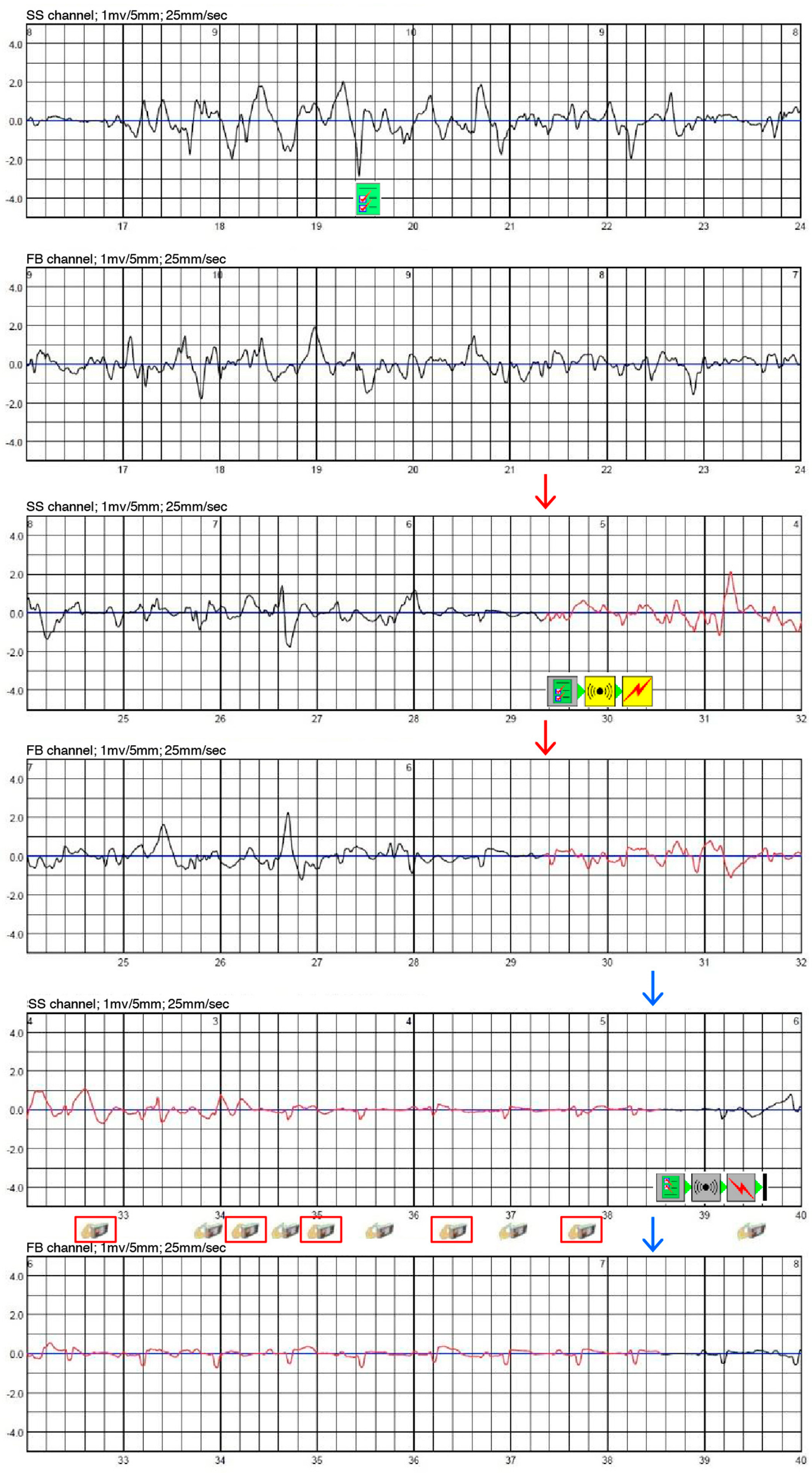 False Alarms in Wearable Cardioverter Defibrillators—A Relevant Issue ...