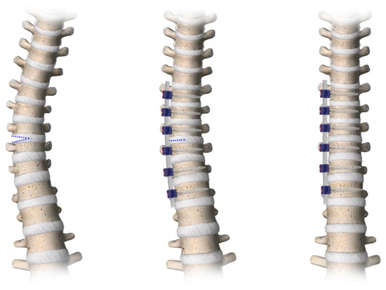 Anterior Vertebral Body Tethering (AVBT) in the Treatment of Adolescent ...