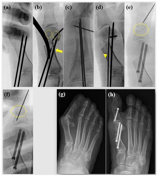 Results of Modified Minimally Invasive Hallux Valgus Surgery, Factors ...