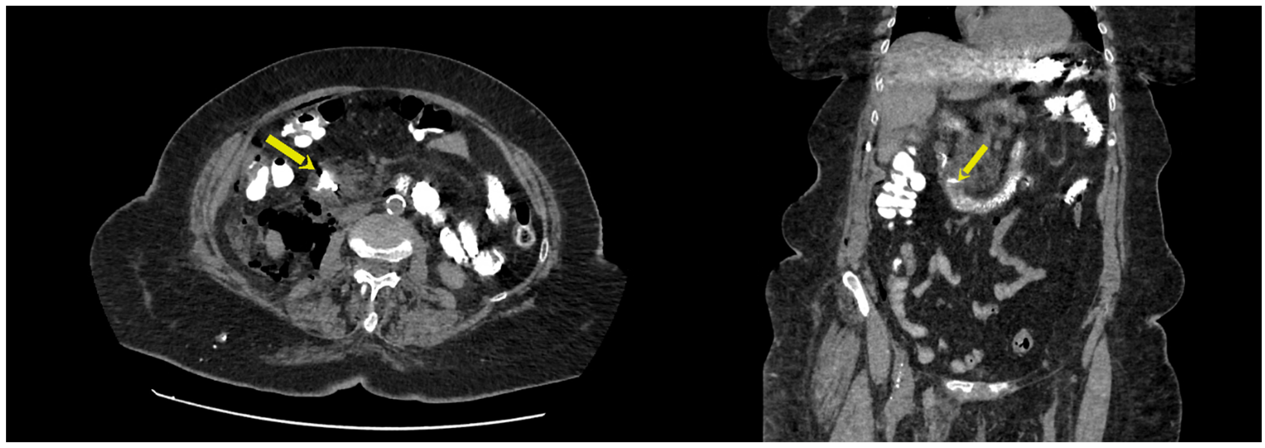 Management of ERCP-Related Perforations: A Single-Center Experience