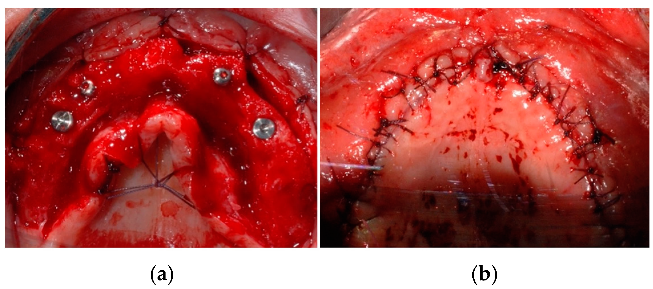 Use of Deproteinized Bovine Bone in Association with Calcium Sulphate ...