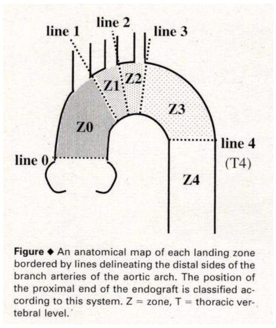 General Information and Applications of Najuta Fenestrated Stent Grafts ...