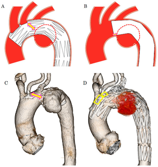 General Information and Applications of Najuta Fenestrated Stent Grafts ...