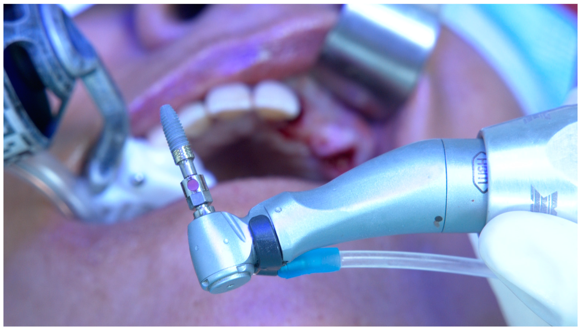 Single Teeth and Partial Implant Rehabilitations Using Ultra ...