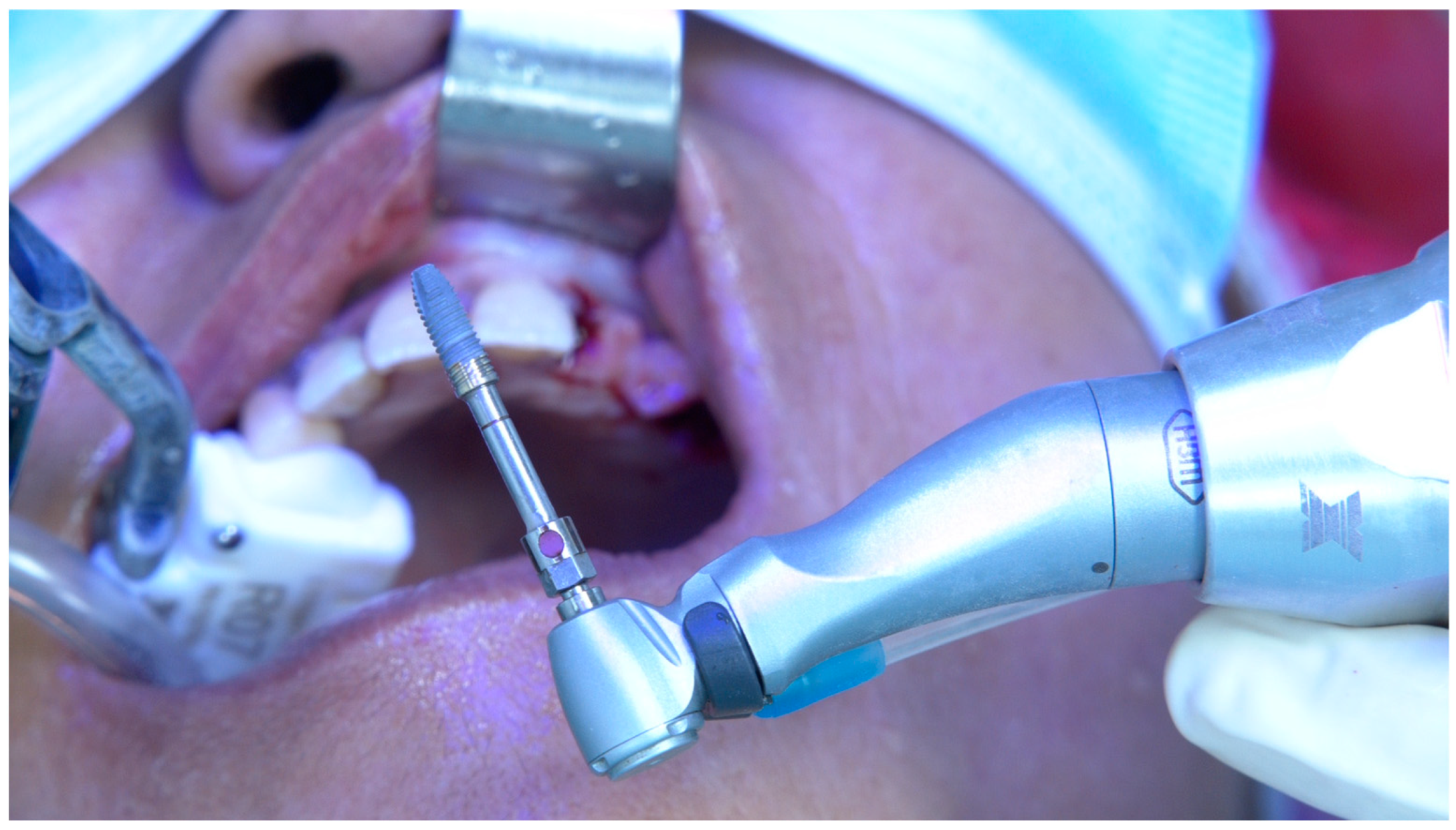 Single Teeth and Partial Implant Rehabilitations Using Ultra ...
