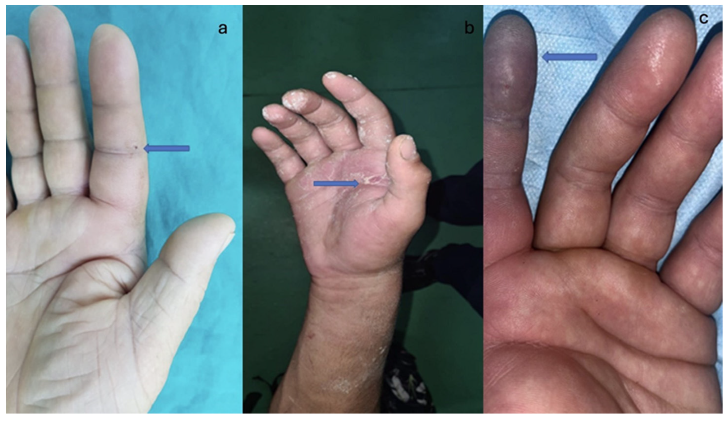 High-Pressure Injection Injury of the Hand—A Rare but True Surgical Emergency