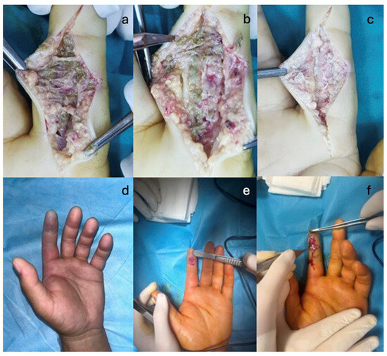 High-Pressure Injection Injury of the Hand—A Rare but True Surgical ...