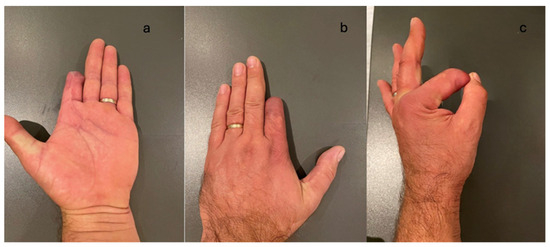 High-Pressure Injection Injury of the Hand—A Rare but True Surgical ...